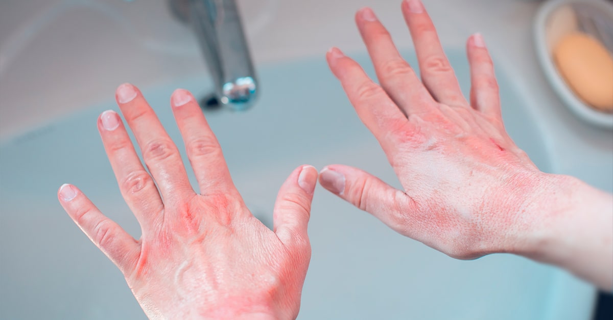 Er det irritativt eller allergisk håndeksem? - Astma-Allergi Danmark
