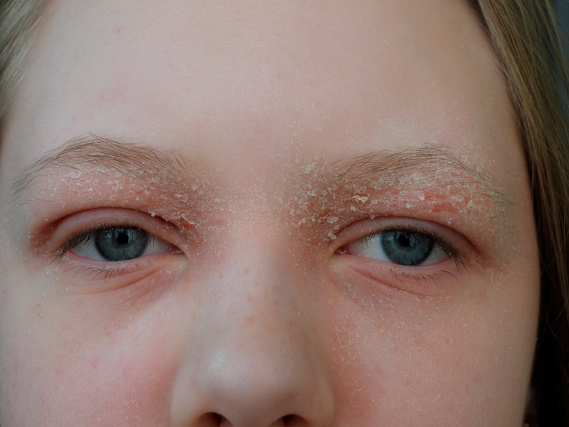 Hvordan ser atopisk eksem ud? - Astma-Allergi Danmark